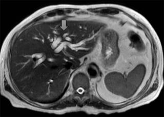 Diagnóstico de obstrucción de la vía biliar por colangiorresonancia ...