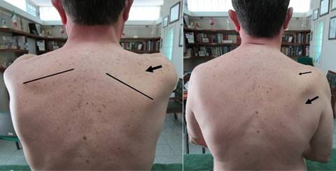 Lesión del nervio supraescapular