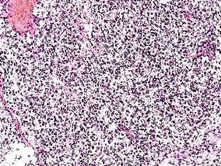 Sarcoma sinovial de extremidad inferior