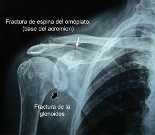 Fractura Escapular Wikipedia A Enciclopedia Libre