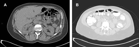 Neumatosis intestinal