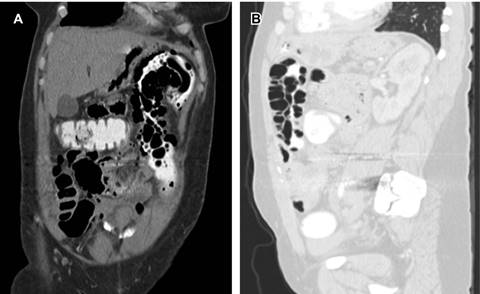 Neumatosis intestinal