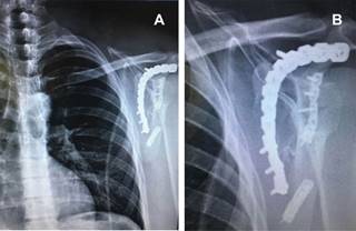 Fractura compleja de escápula