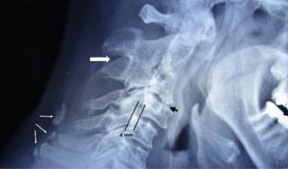 Sinostosis cervical C2-C3: síndrome de Klippel-Feil