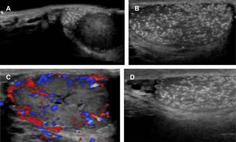 Microlitiasis testicular asociada a seminoma