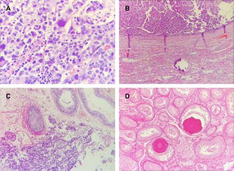 Microlitiasis testicular asociada a seminoma