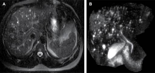 Enfermedad de Caroli