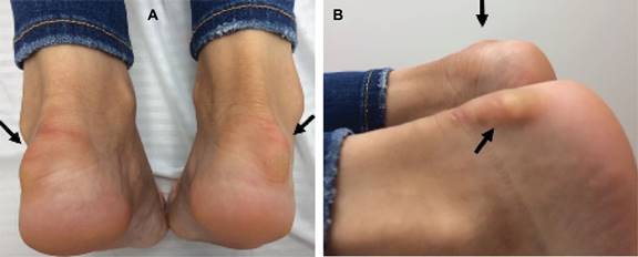 Síndrome y deformidad de Haglund