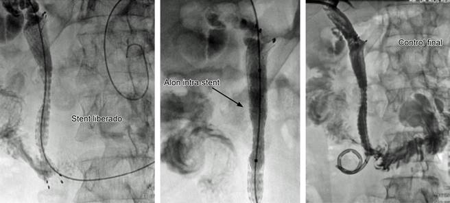 Experiencia de drenaje biliar percutáneo en pacientes del Hospital ...