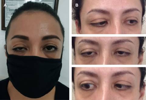 Síndrome de Miller Fisher y polineuritis craneal como manifestación de ...