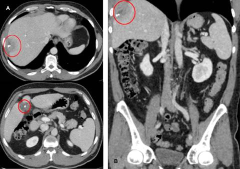 Síndrome postcolecistectomía por cálculos biliares caídos