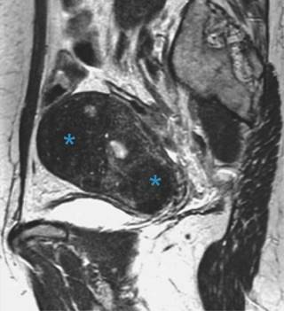 Prevalencia de adenomiomas y hallazgos asociados en estudios de ...