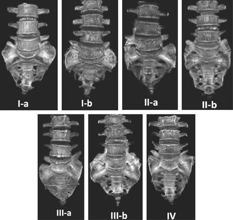 Incidencia de la anormalidad de la vértebra de transición, en la ...