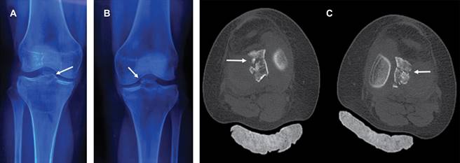 Fractura de espina tibial bilateral en adulto