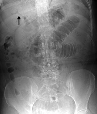 Íleo biliar resuelto por laparoscopia. A propósito de un caso