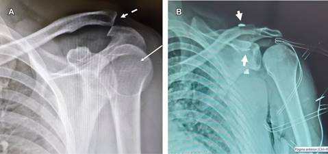 Luxación glenohumeral posterior asociada a luxación acromioclavicular ...