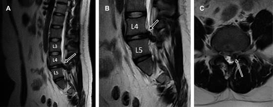 Hernia discal traumática grado III a nivel L4/L5. Diagnóstico infrecuente