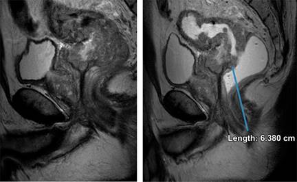 Utilidad de la resonancia magnética en la estadificación del cáncer de ...