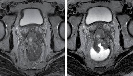 Utilidad de la resonancia magnética en la estadificación del cáncer de ...