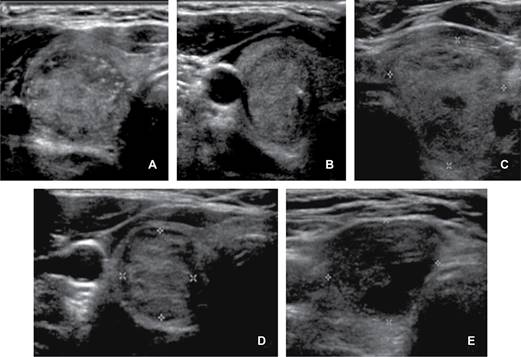 Asociación histopatológica de hallazgos ultrasonográficos en nódulos ...