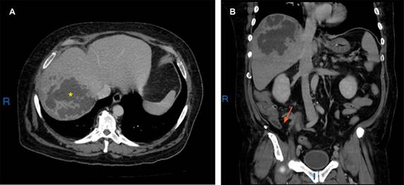 Absceso hepático piógeno secundario a apendicitis del muñón