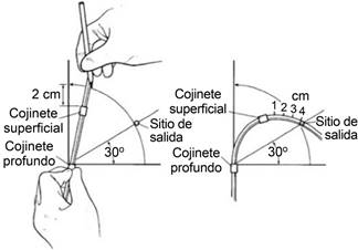 Catéter Tenckhoff para el cirujano general: aspectos teóricos y técnica ...