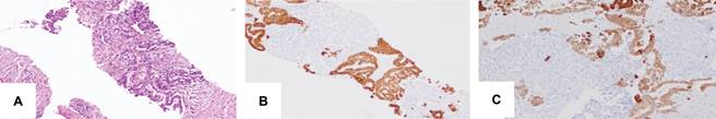 Tumor de Klatskin: colangiocarcinoma hiliar