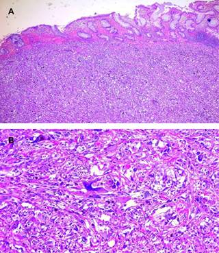Melanoma anorrectal, una neoplasia poco común