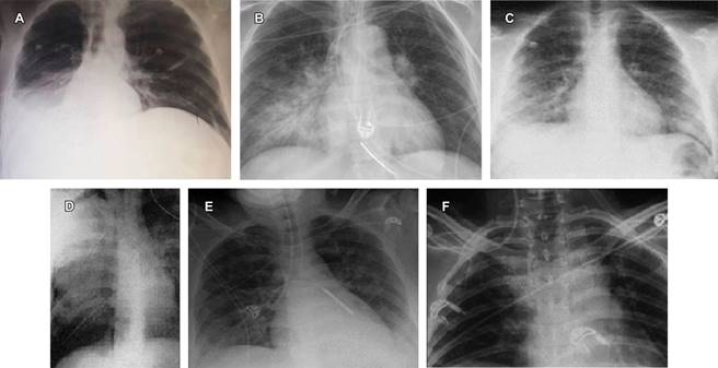Radiología e imagen del tórax en la Unidad de Terapia Intensiva