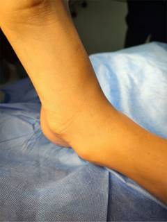 Tratamiento del escafoides accesorio sintomático