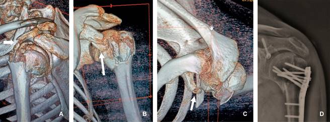Fractura-luxación de cabeza humeral asociada a fractura avulsión de ...