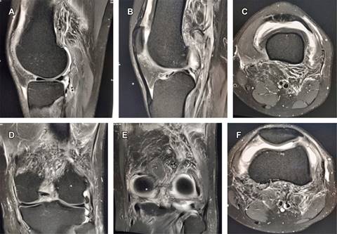 Sinovitis villonodular pigmentada en rodilla