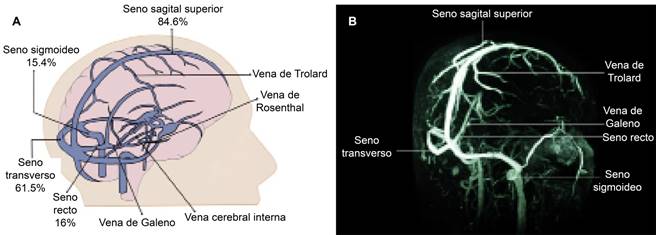 Trombosis venosa cerebral: perspectivas actuales