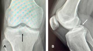Fractura avulsión de la inserción distal del ligamento cruzado ...