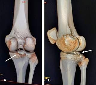Fractura avulsión de la inserción distal del ligamento cruzado ...