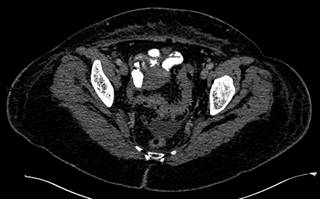 Pileflebitis, una complicación poco frecuente de la diverticulitis