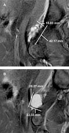 Hallazgos en resonancia magnética del quiste paralabral de cadera