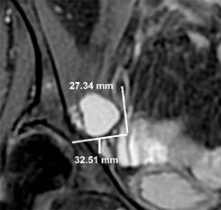 Hallazgos en resonancia magnética del quiste paralabral de cadera