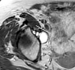 Hallazgos en resonancia magnética del quiste paralabral de cadera