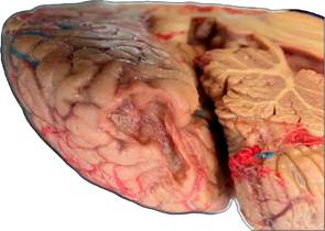 Atrofia cortical posterior, presentación de un caso