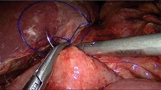 Manejo de perforación tardía de úlcera yeyunal no marginal en paciente ...