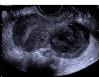 Embarazo ectópico crónico