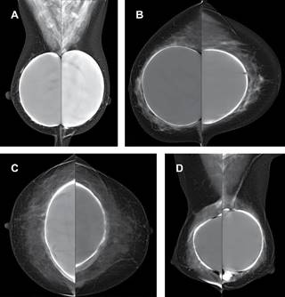 Valoración por mastografía y ultrasonido de implantes mamarios y sus ...