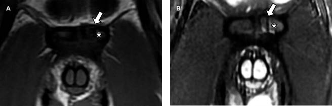 Pubalgia deportiva. Desafío diagnóstico del dolor inguinal