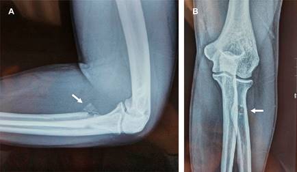 Fractura avulsión del tendón distal del bíceps braquial en fisicoculturista