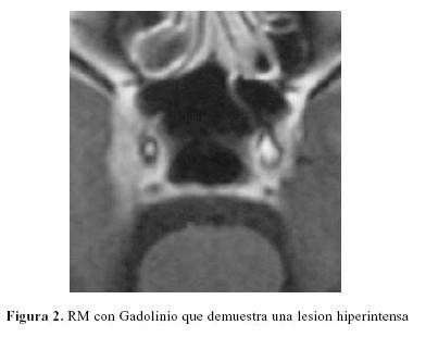 Tuberculoma del seno cavernoso