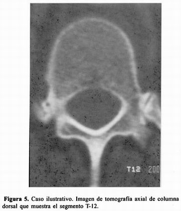 Vertebroplastía percutánea