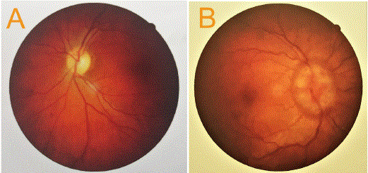 Foster Kennedy Syndrome: Revisiting a Classical Phenomenon