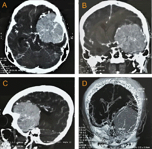 Foster Kennedy Syndrome: Revisiting a Classical Phenomenon