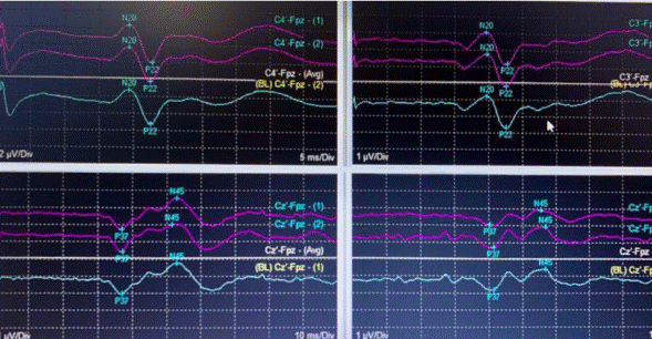 Monitoreo neurofisiológico intraoperatorio, lo que el anestesiólogo ...